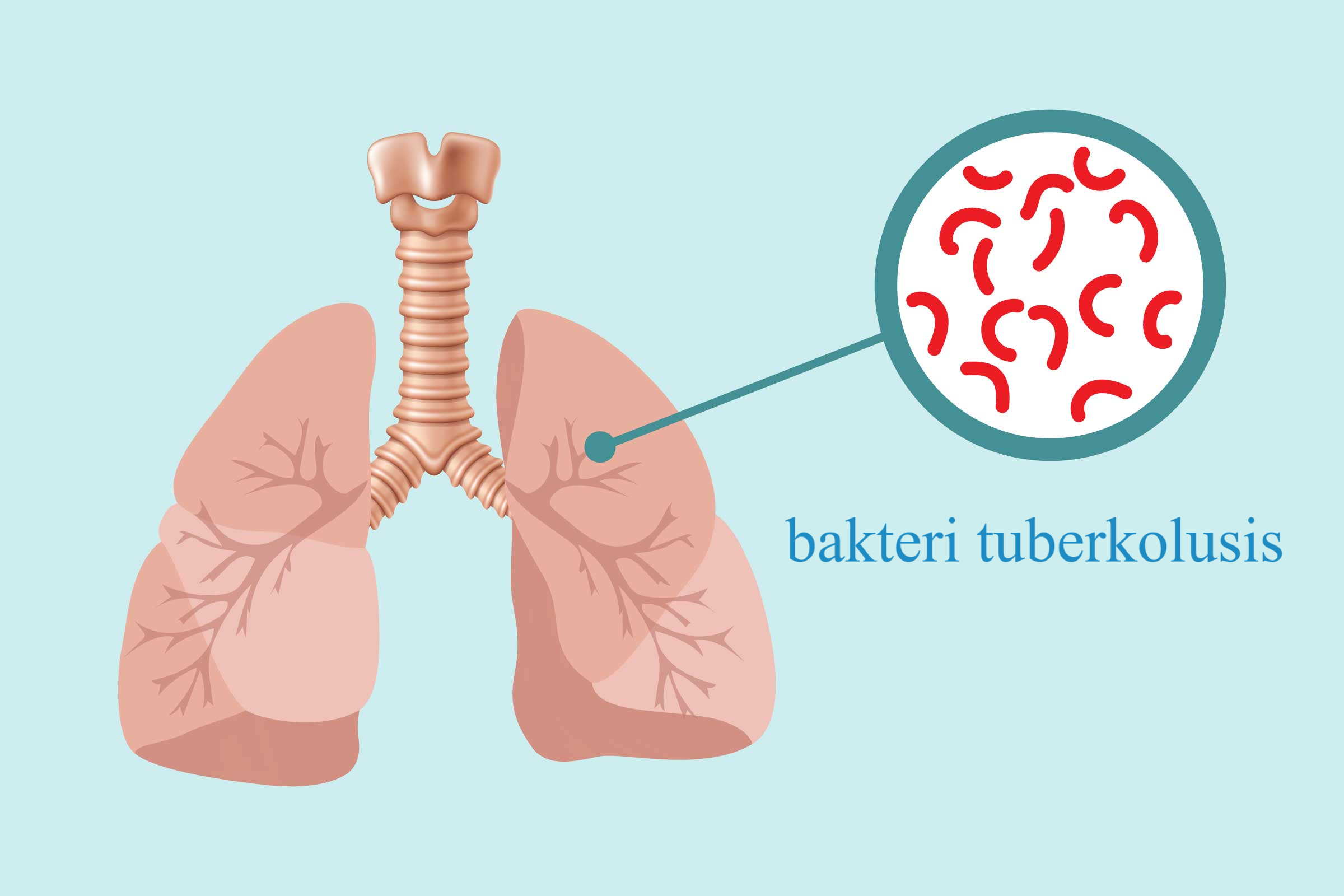 Gejala Penyakit Tuberkulosis (TBC): Tanda, Gejala, dan Penanganannya ...