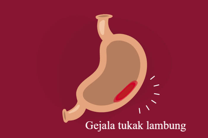 Gejala Penyakit Tukak Lambung Kenali Tanda Tandanya Dan Cara Mengatasinya Esatuid