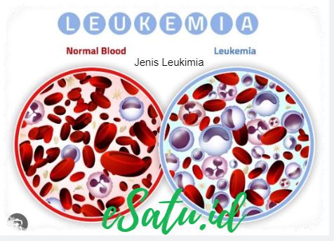 Ada Berapa Jenis Penyakit leukemia? Yuk Simak Pemaparan Disini.