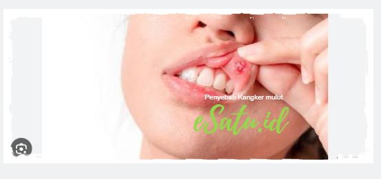 Gejala dan Penyebab Kanker Mulut Yang Patut Kita Waspadai.