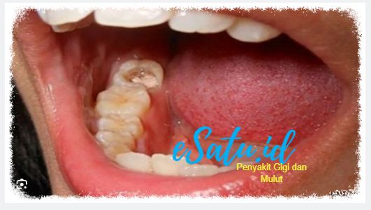 Waspadai Penyakit Gigi dan Mulut Mulai Dari Sekarang,Yuk Simak Apa saja.